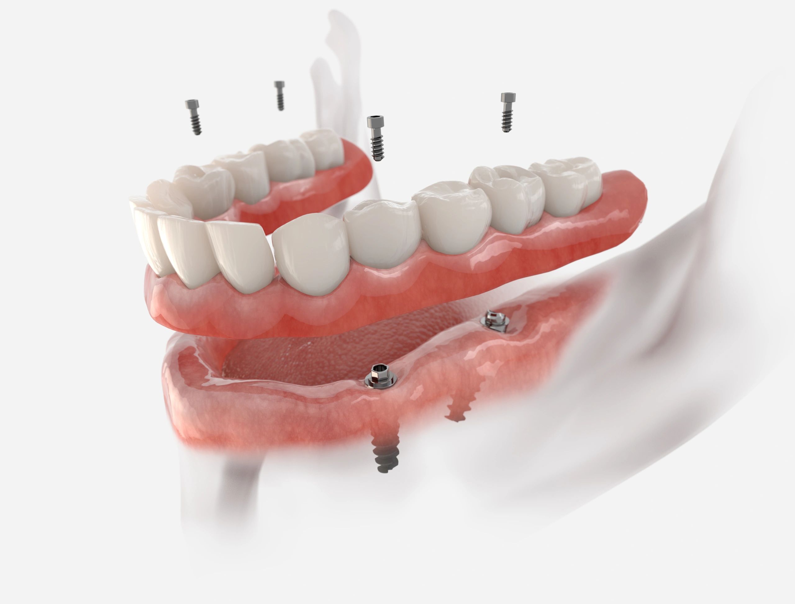 SmileX-All-on-4 Lab and Provider Solutions