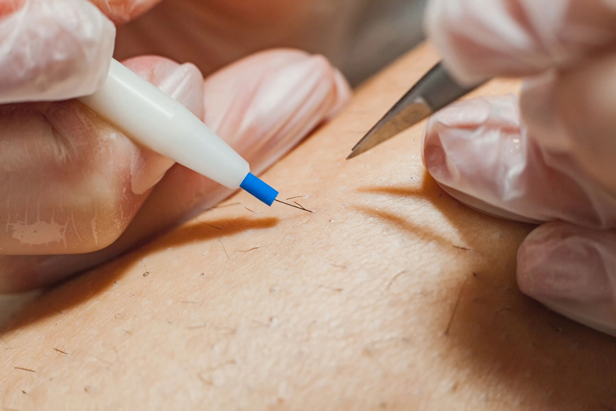 Electrolysis by Chandra: Expert Hair Removal Services in Portland Oregon