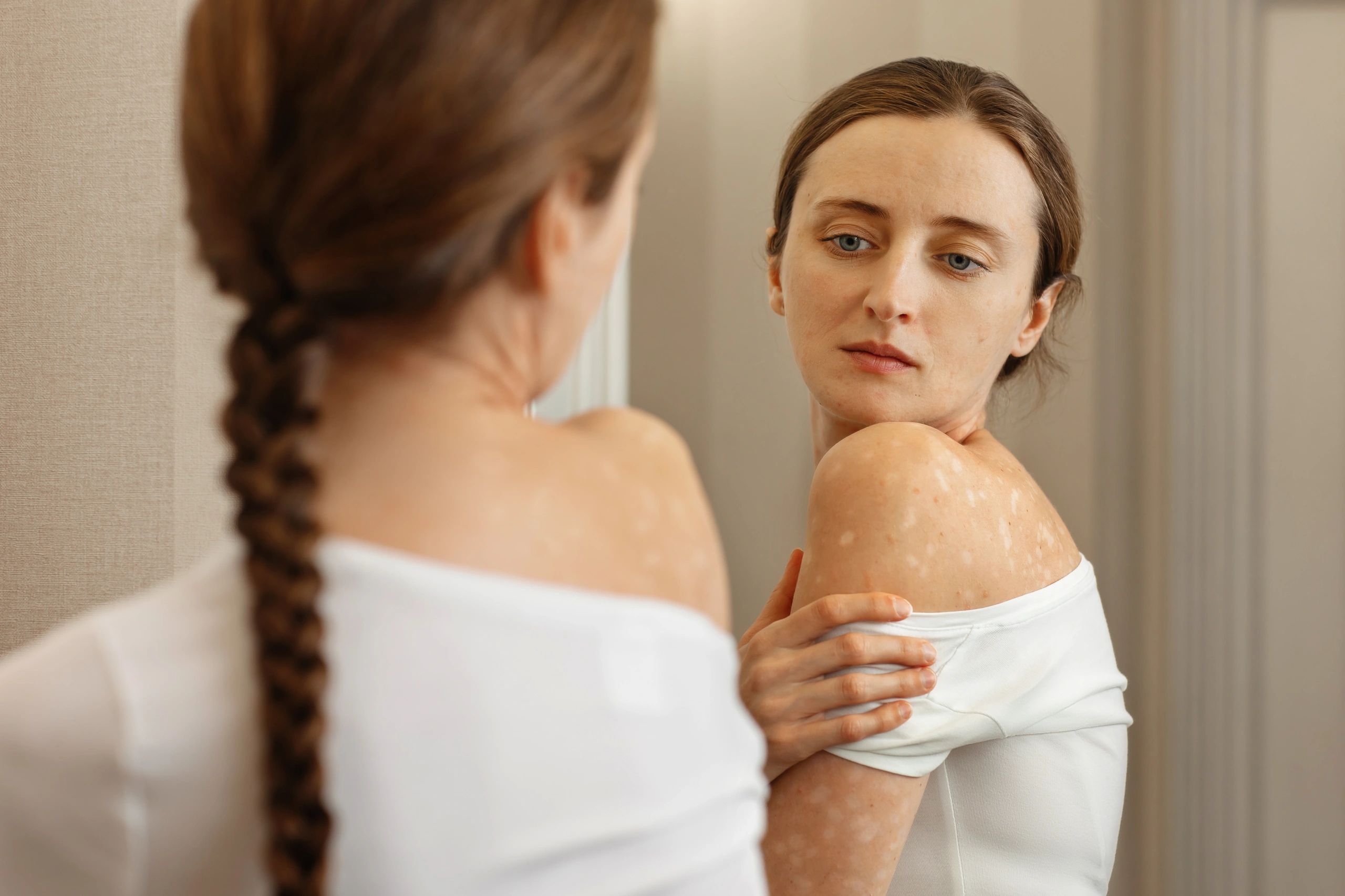 Effective Leukoderma Treatment | New patented formula