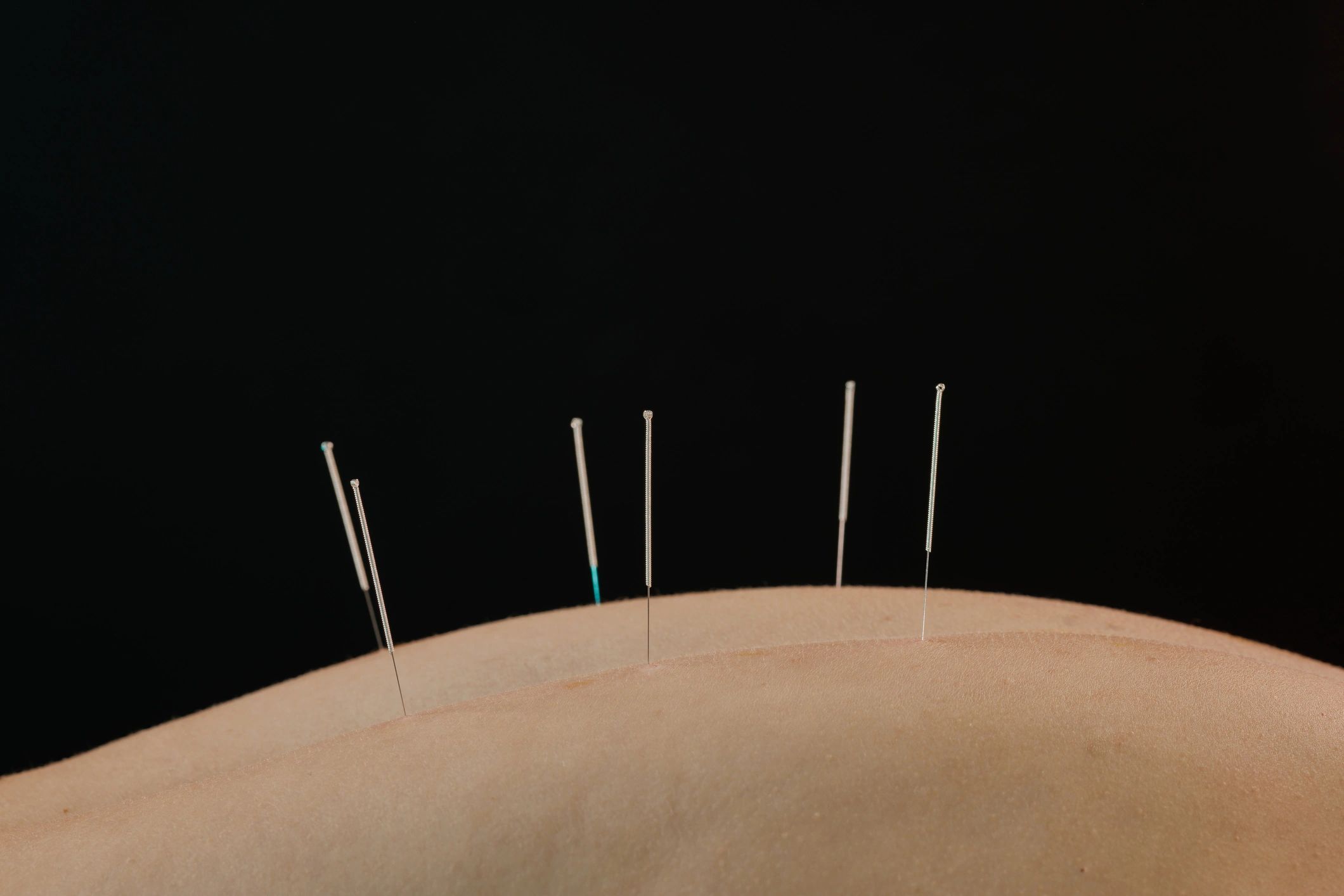 Northwest Indiana Massage & Acupuncture Services