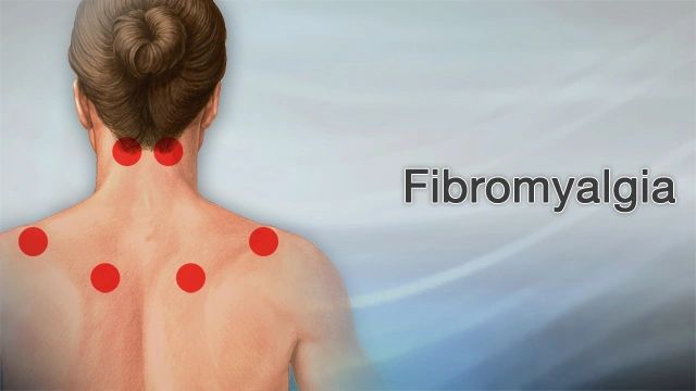 Understanding Fibromyalgia - A Comprehensive Guide