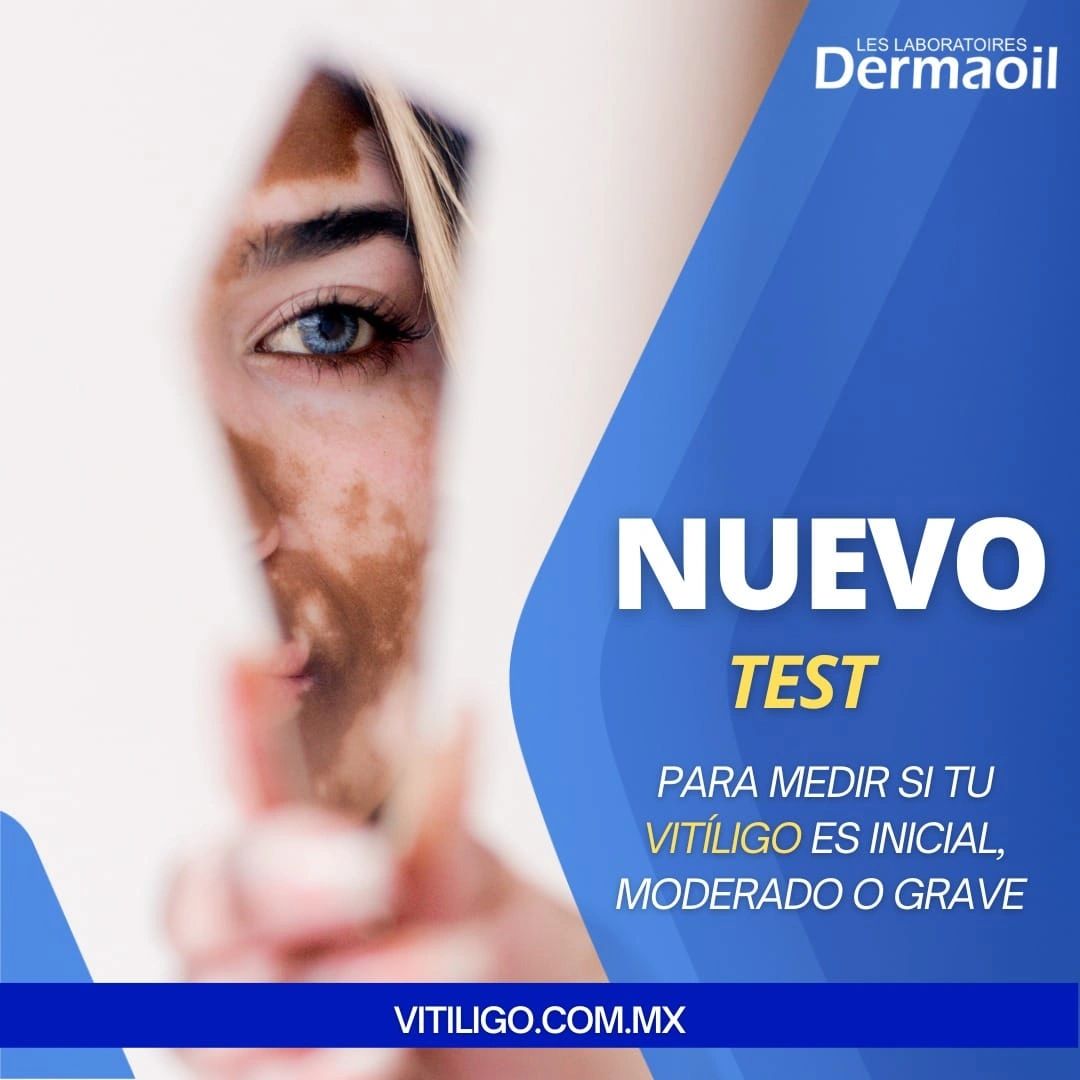 NUEVO TEST PARA MEDIR SI TU VITÍLIGO ES INICIAL, MODERADO O GRAVE
