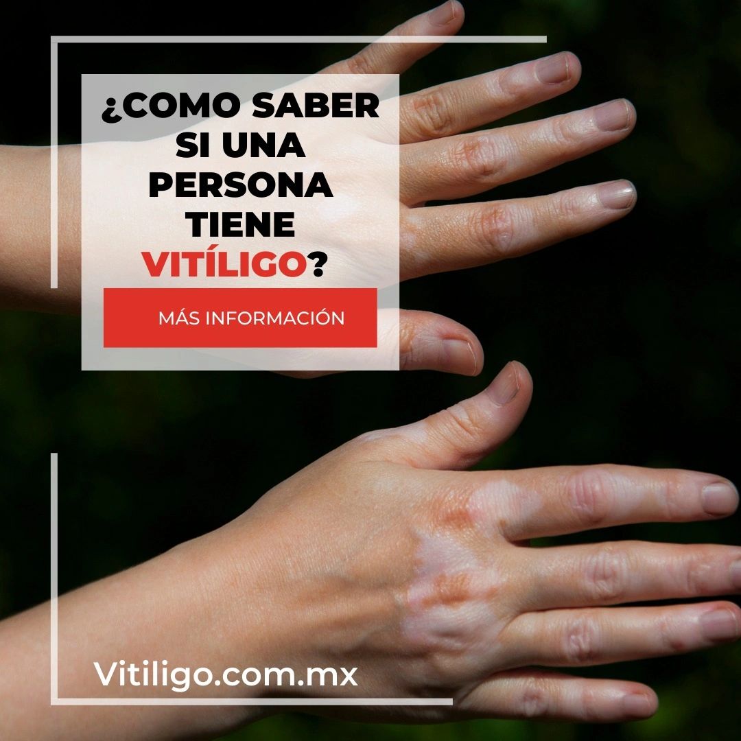 ¿Como saber si una persona tiene Vitíligo?
