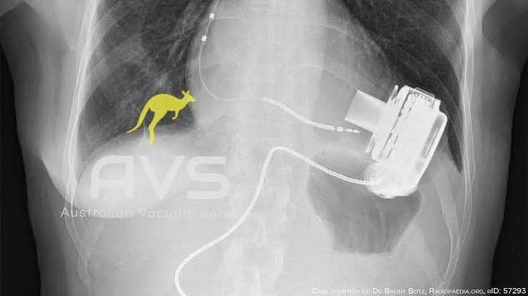 Biomedical implant coating technology