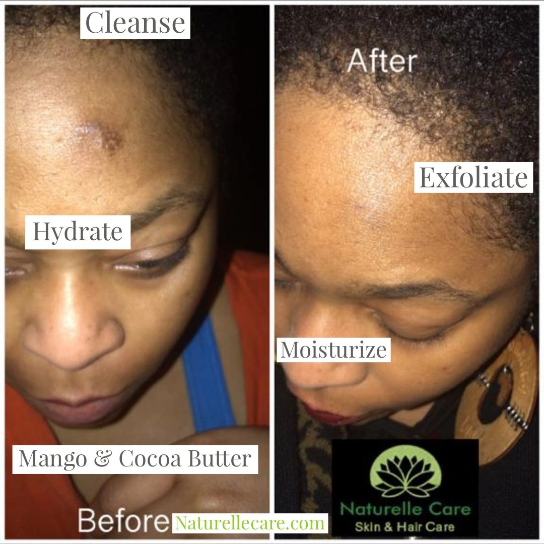 SCARS & STRETCH MARKS