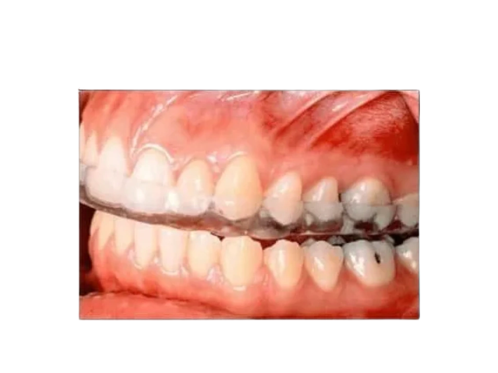 Hard occlusal splint