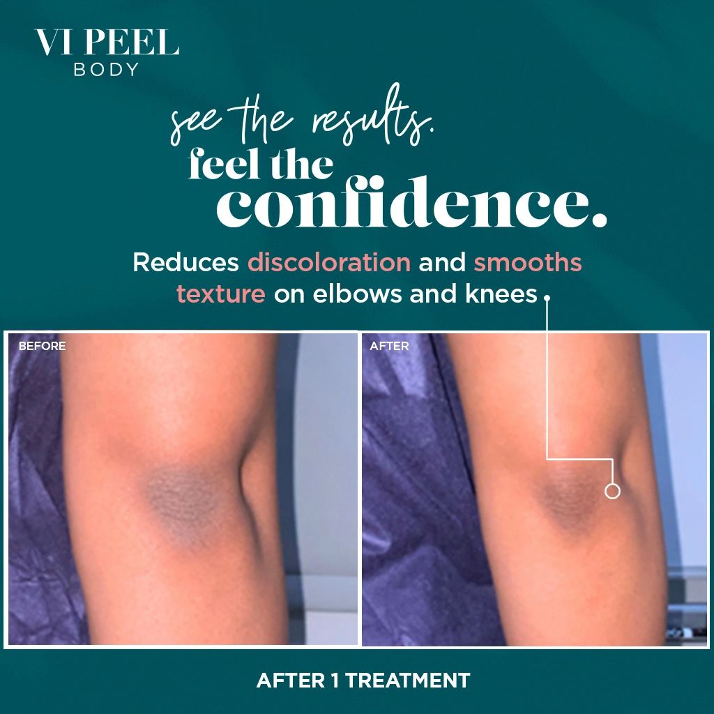 Introduction to the VI Body Peel Kit - Zoom Meeting