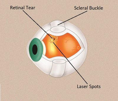 Mohawk Valley Retina - Scleral Buckle - New Hartford, New York | Mohawk ...