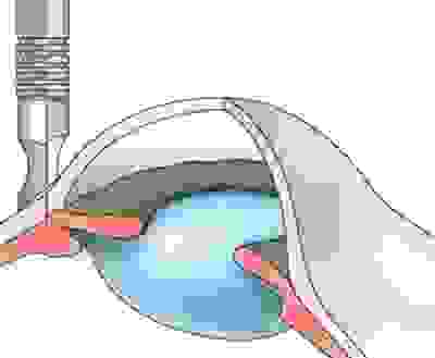 Mohawk Valley Retina - Ciliary Body Ablation - New Hartford, New York ...