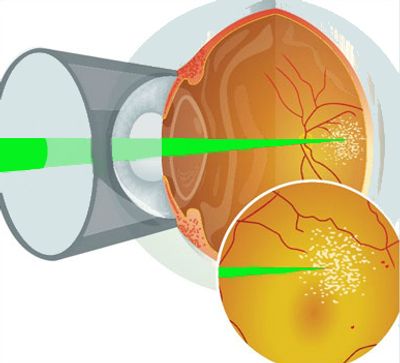 Mohawk Valley Retina - Focal Laser - New Hartford, New York
