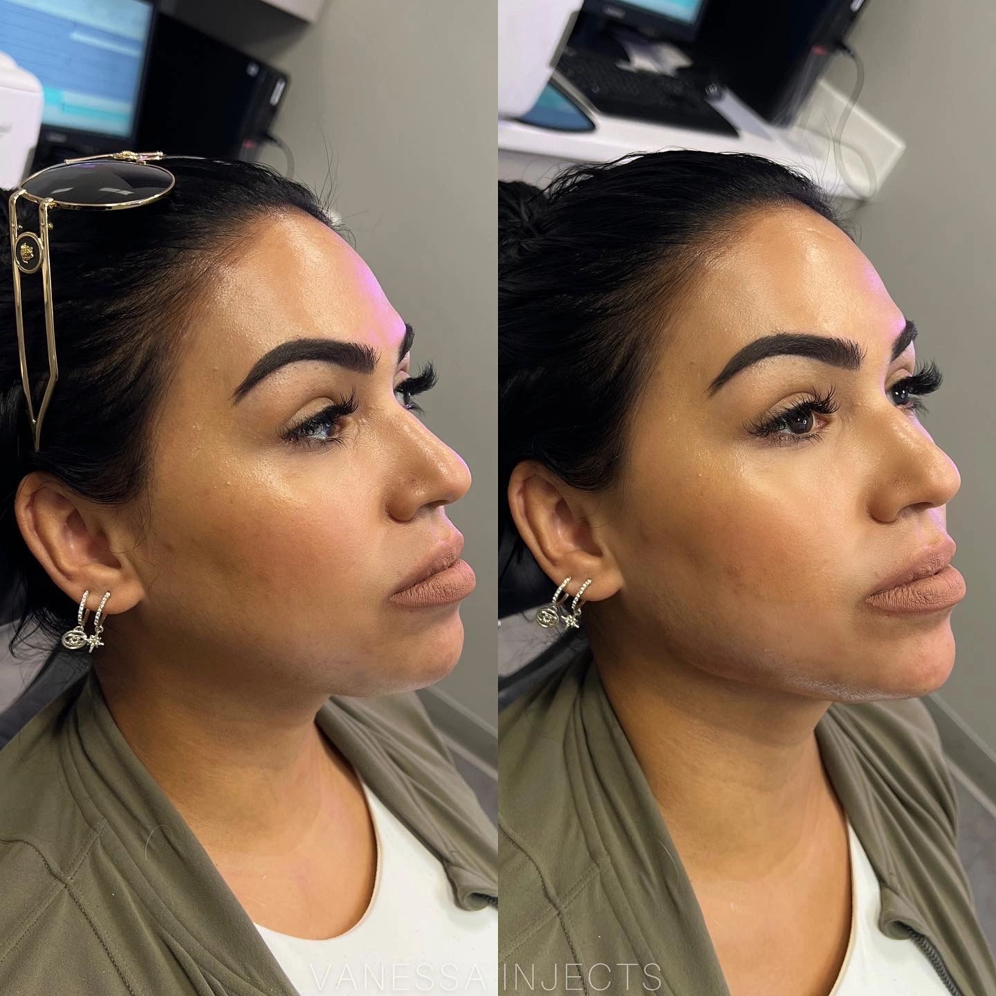 Jawline Contouring | Vanessa Injects