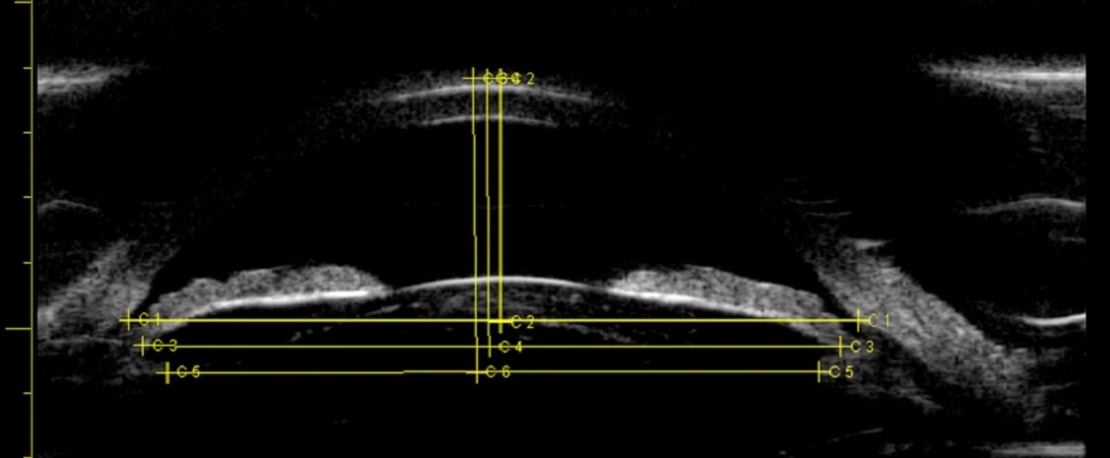 Quantitative AS-UBM | Anterior Segment Imaging