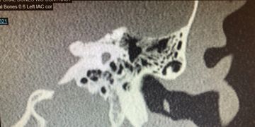 My Journey Dealing with Superior Canal Dehiscence Syndrome and my SCDC ...