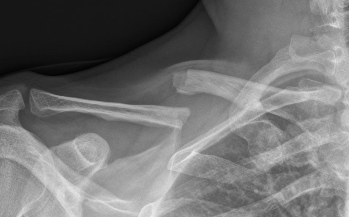 Tratamiento de la Fractura de Clavícula