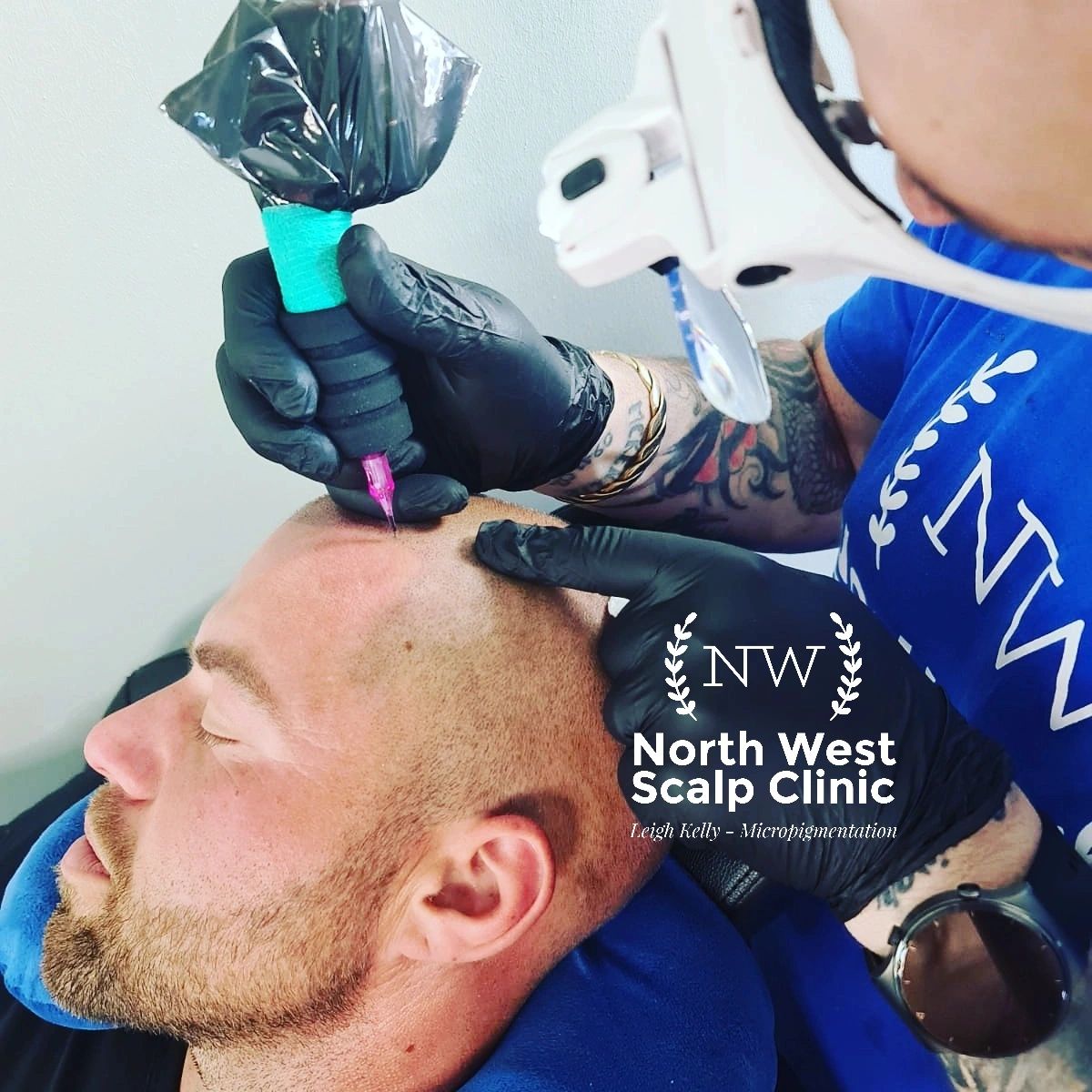 Free Consultation, SMP Hairline & Balding Tattoo - Wigan, Manchester ...