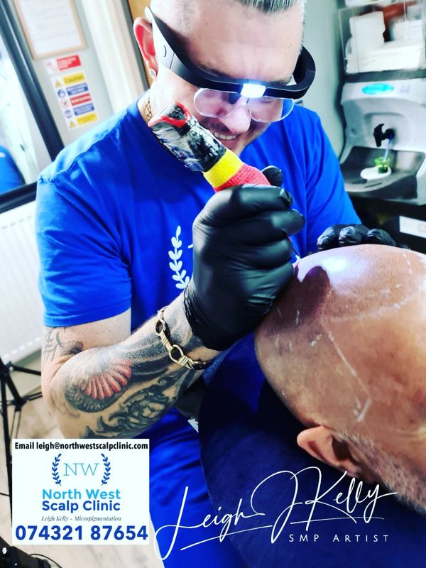 Scalp Micropigmentation Wigan | Hair Tattoo Manchester | Visit The ...