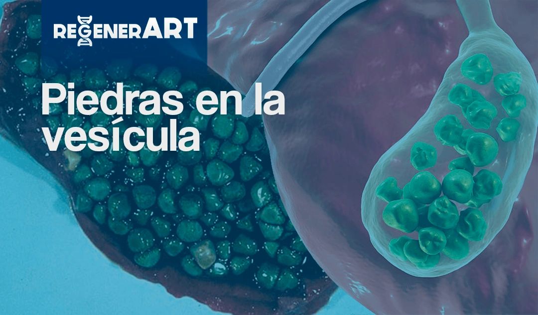 Cálculos biliares o piedras en la vesícula