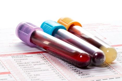 Noninvasive Diagnostics to Detect Advanced Fibrosis: ELF & Fib-4