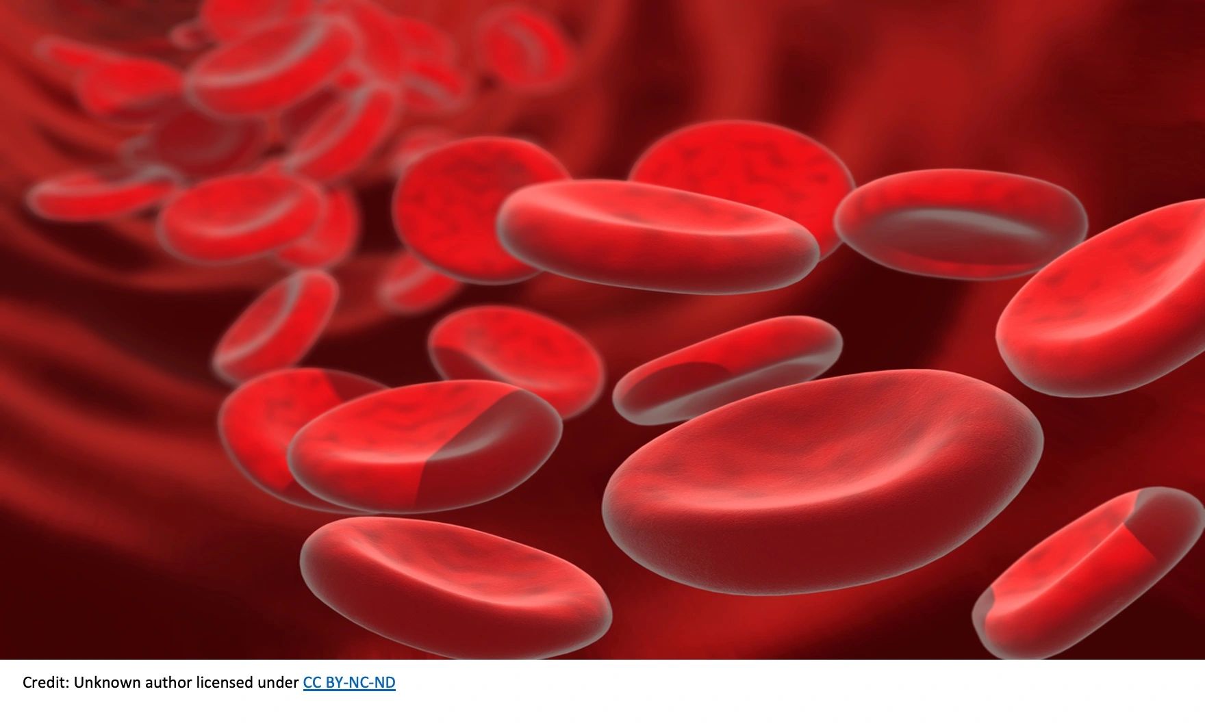 Elevated Iron levels in NAFLD Linked to increased Risk of HCC