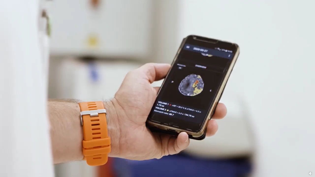 Artificial intelligence revolutionising NHS stroke care Artificial intelligence revolutionising NHS stroke care
