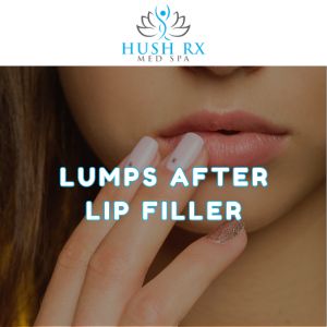 Lip Filler Bumps: Is it Normal and When Will They Go Away?