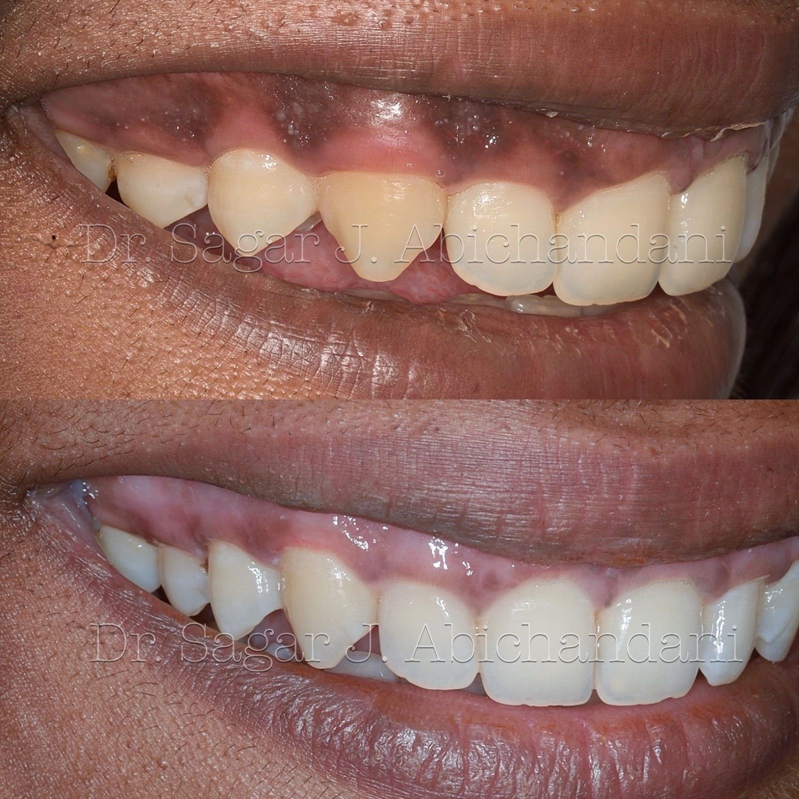 Laser Gum Depigmentation Cost per Quadrant: An In-Depth Guide
