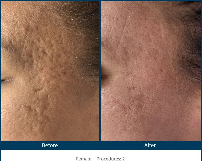 Microneedling for Acne Scars: How SkinPen Helps Fade Deep Scarrin