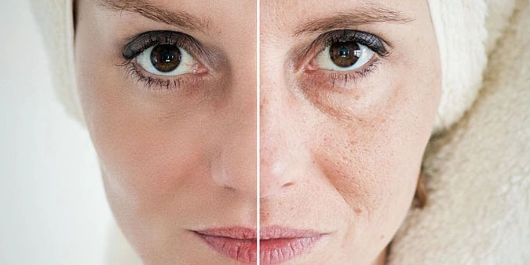 How Sugar Speeds Up Skin Aging: Understanding Skin Glycation