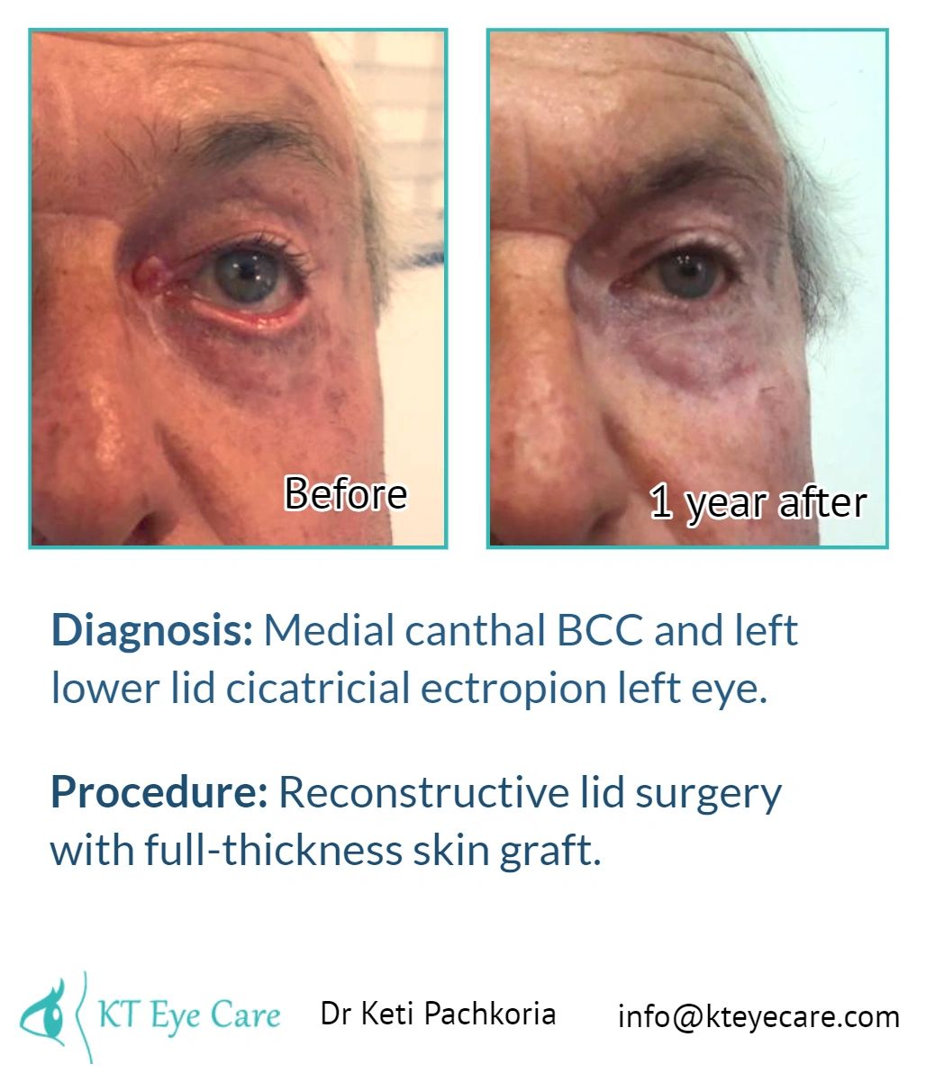 Functional & aesthetic restoration of the periocular area.