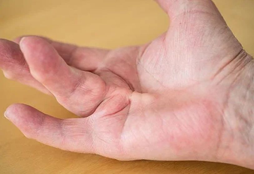 Dupuytren's Contractures