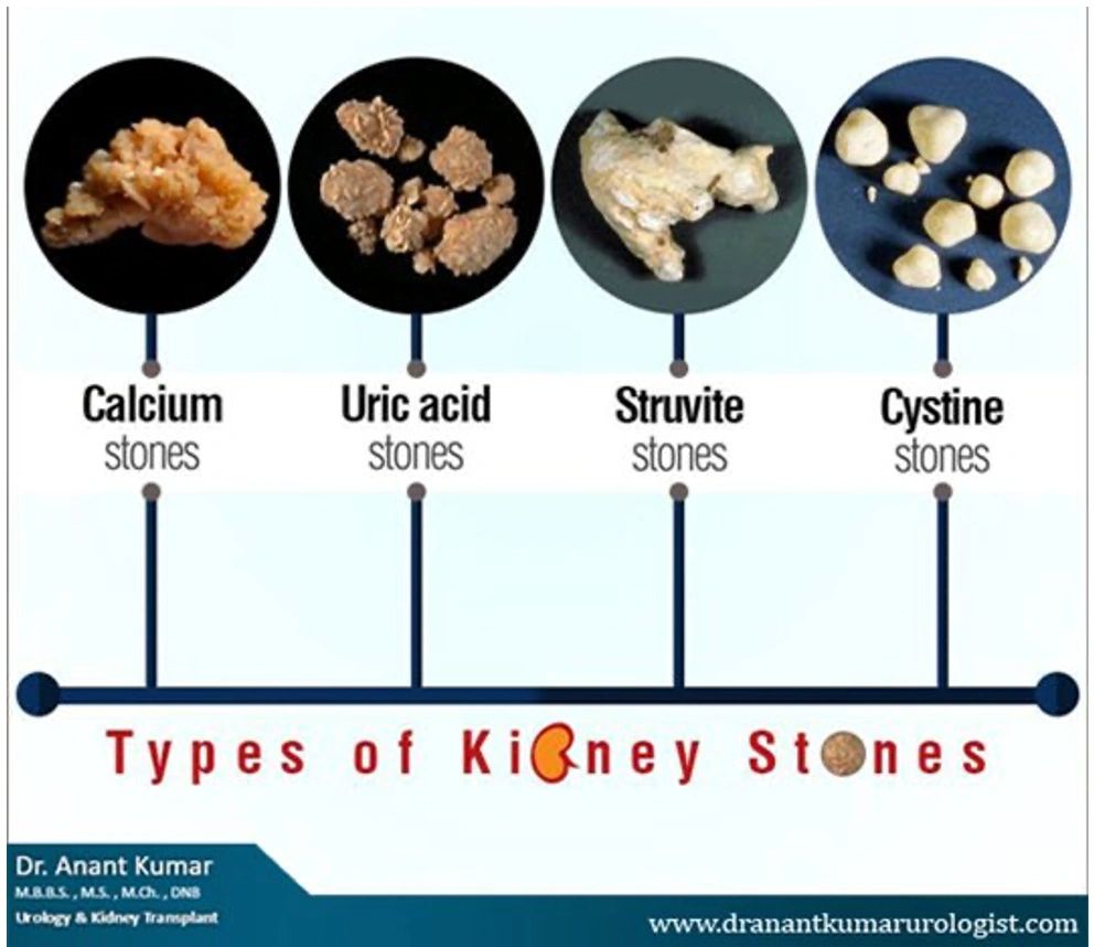 Kidney Stones... ouch!