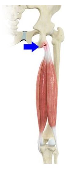 Hamstring Injuries Managed Without Surgery?
