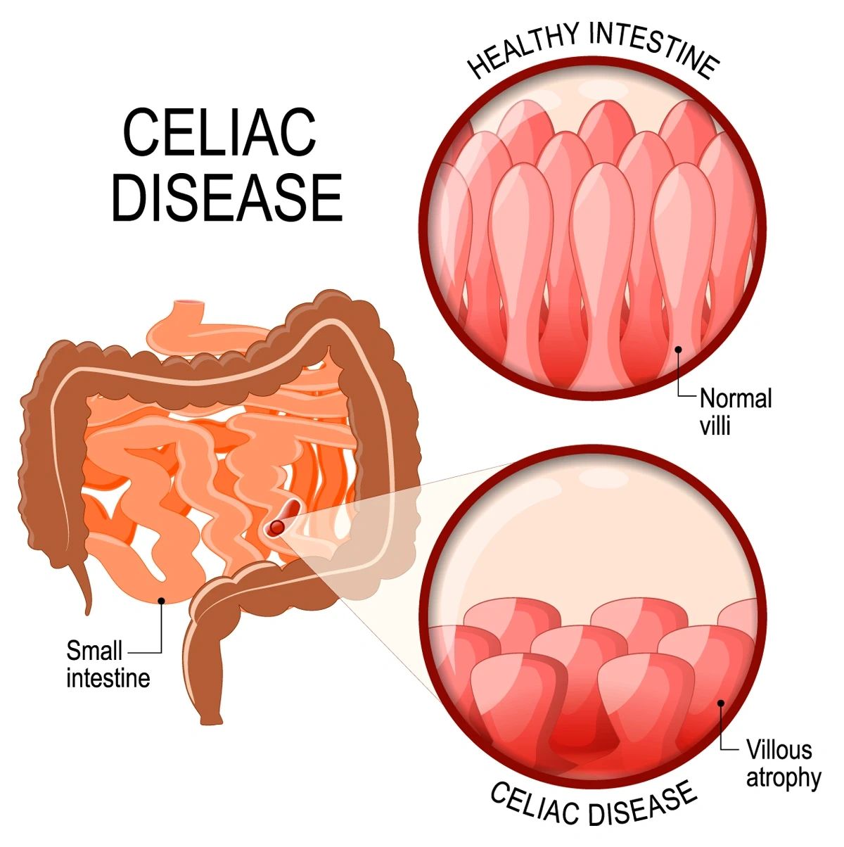 Diagnosing Celiac Disease