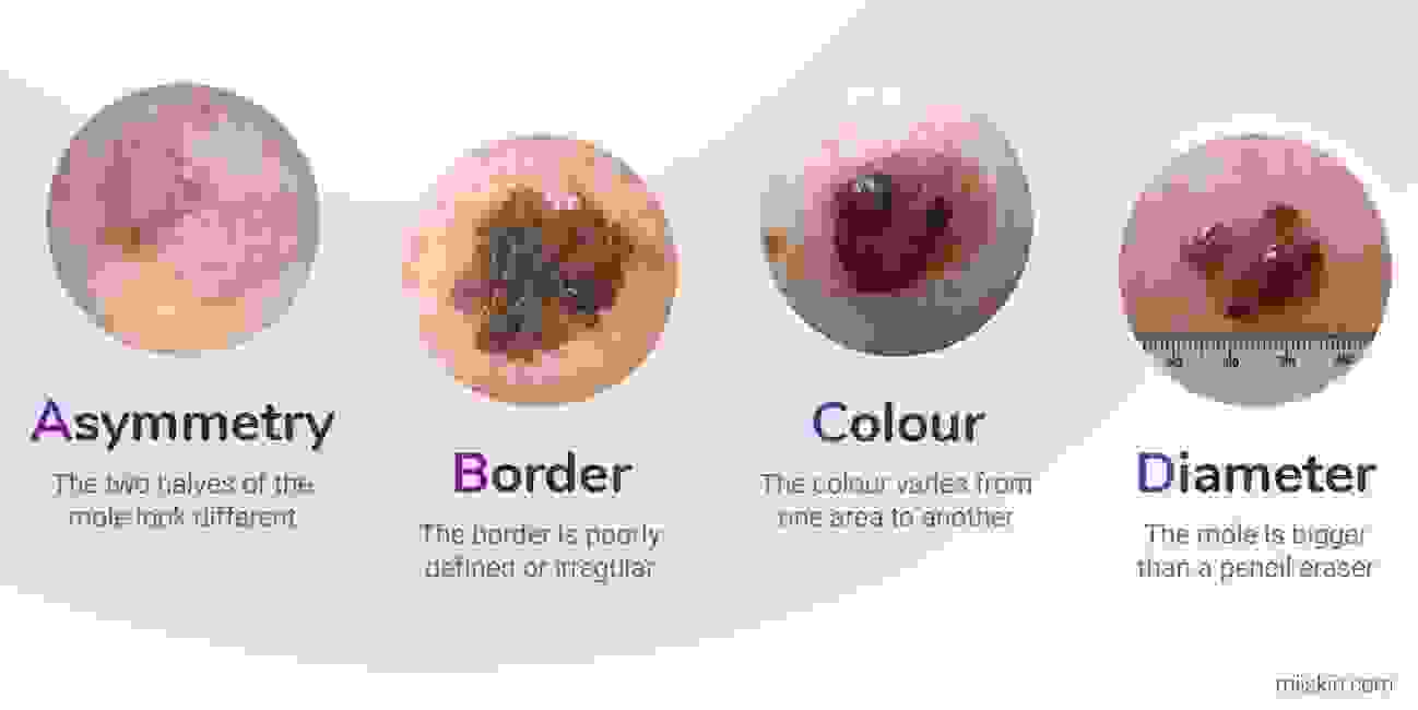 Melanoma | Calgary Skin Cancer Centre