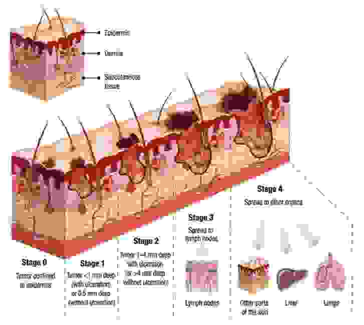 Melanoma | Calgary Skin Cancer Centre
