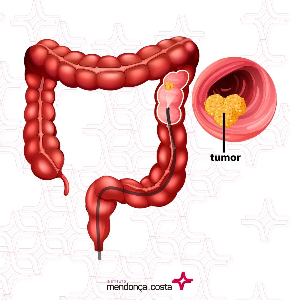 Colonoscopia Com Biopsia Seriada - RETOEDU