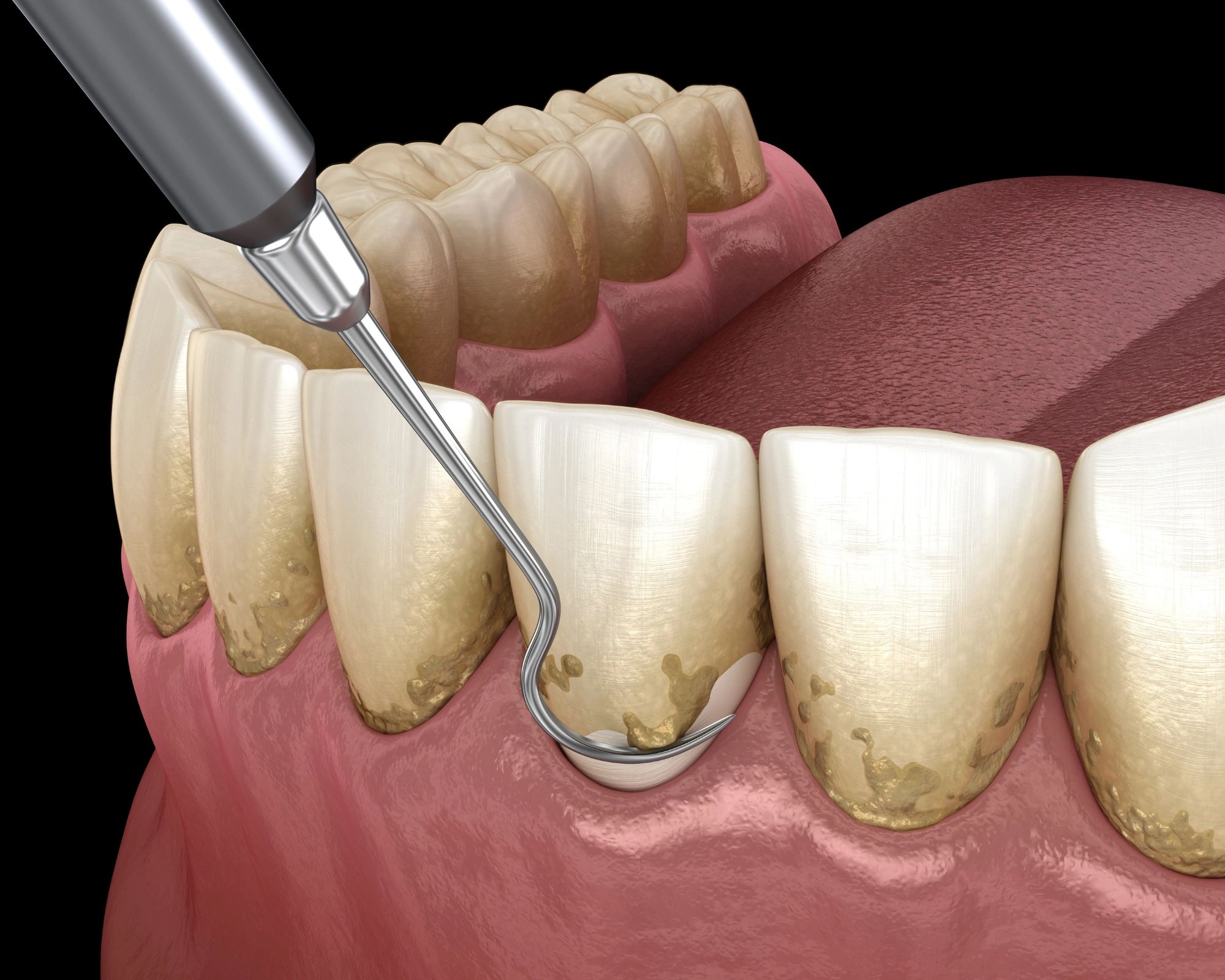 What is Periodontal Debridement?