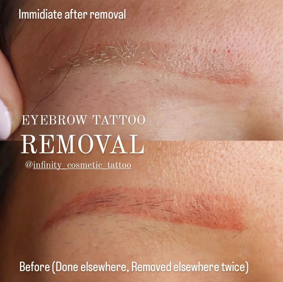 Why Some Eyebrow Tattoos Turn Orange Color After Laser Removal?