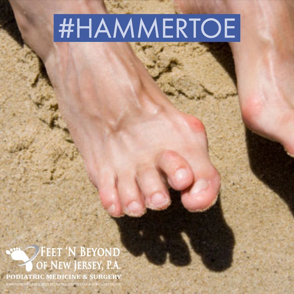Hammertoe