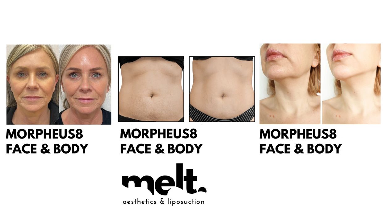 Morpheus8 Face & Body