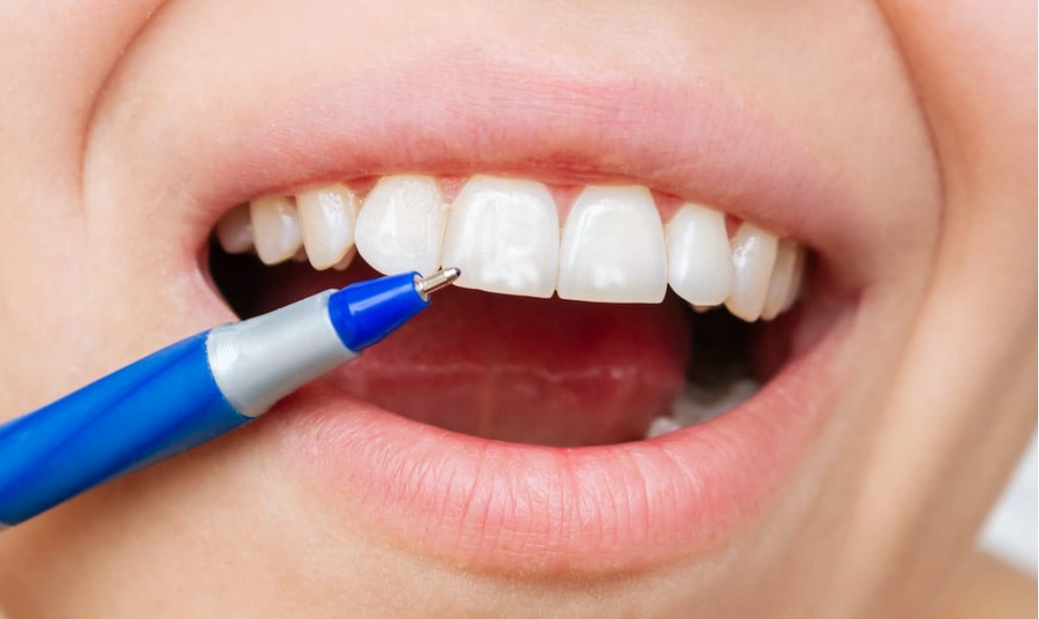 Unveiling the Mystery: What Causes White Spots on Teeth?