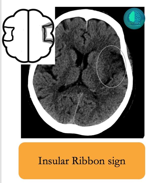 Insular Ribbon Sign