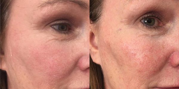 Cosmetic Injections - GV Cosmetics