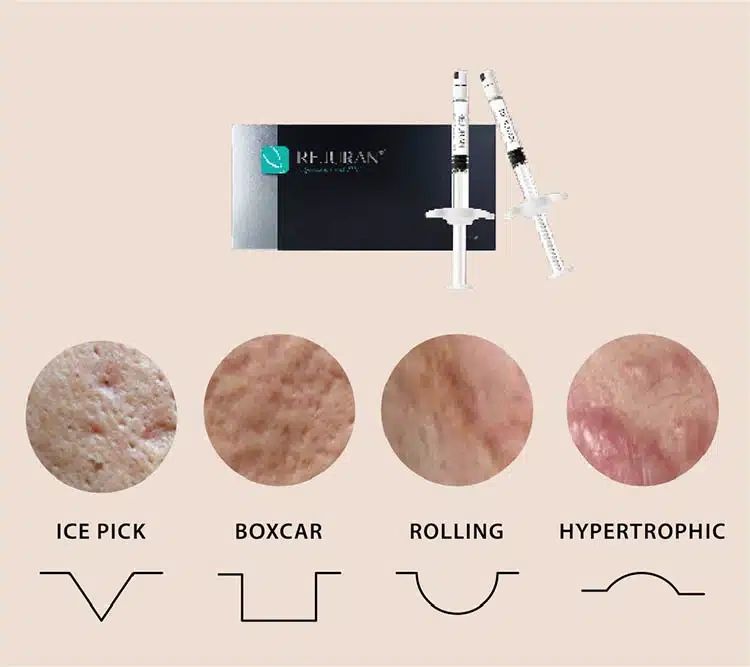 The power of the NEW Scar Treatment called Rejuran- Scar