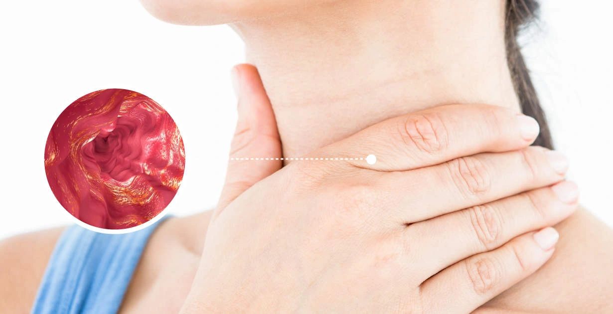 Esofagite - inflamação no esôfago