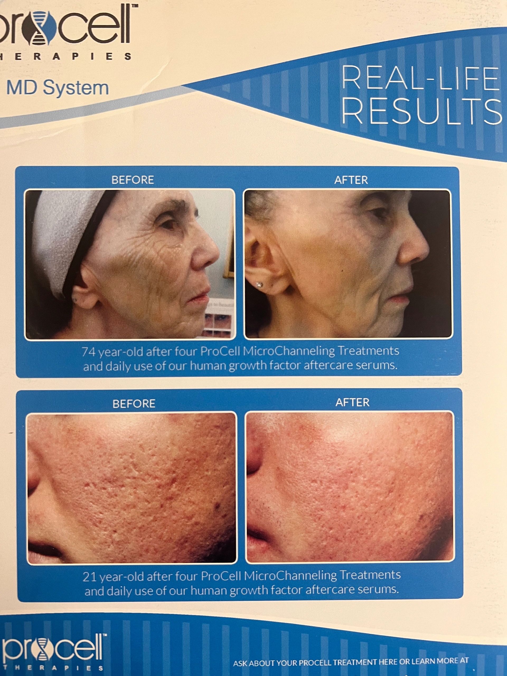 Micro-channeling by Procell for Facial Restoration