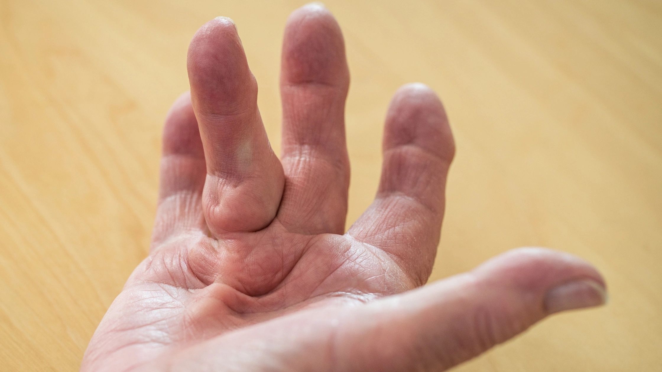Dupuytren’s Contracture Explained: From Diagnosis to Recovery