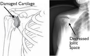 Shoulder Arthritis "Wear and Tear"