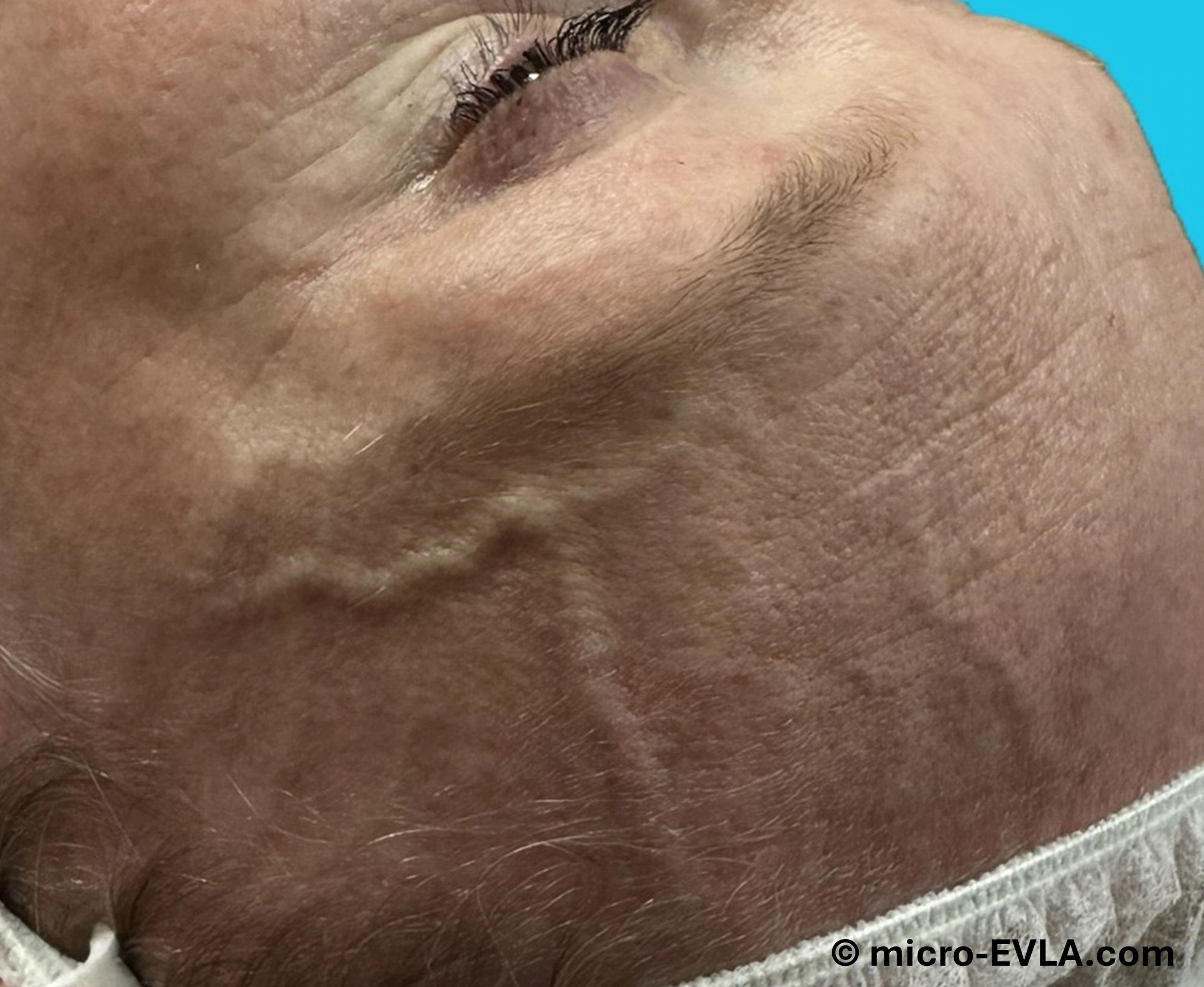 Micro-EVLA Treatment for Facial Veins