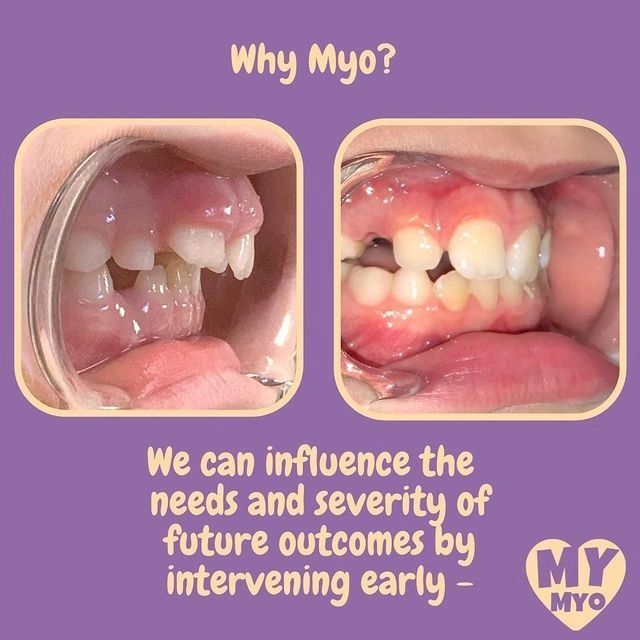 Orofacial myofunctional therapy helps reorganize, coordinate and